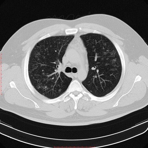 Prüfungsfrage: Welche Veränderungen des interstitiellen ...