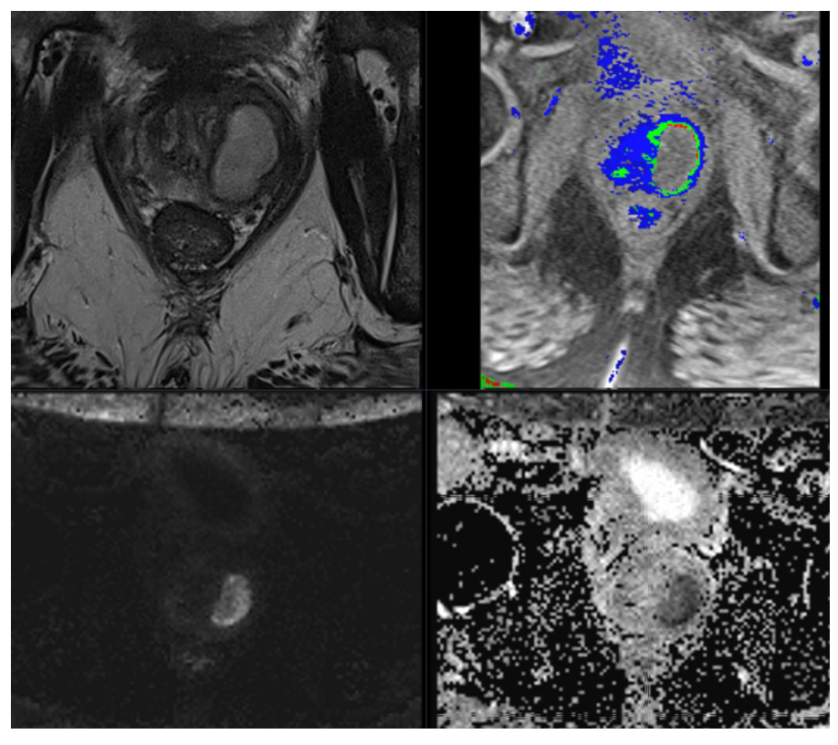 Prüfungsfrage: Ihnen wird ein Patient zum Prostata MRT überwiesen. In ...