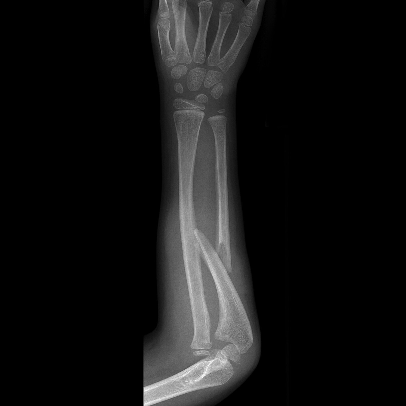 Prüfungsfrage: Kind fällt auf ausgestreckten Arm. Wie nennt sich die ...
